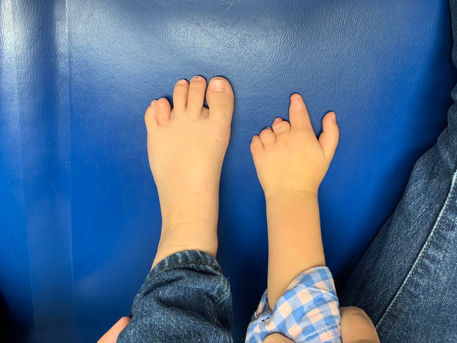 Only a thumb. Amazing outcome! | Congenital Hand and Arm Differences ...