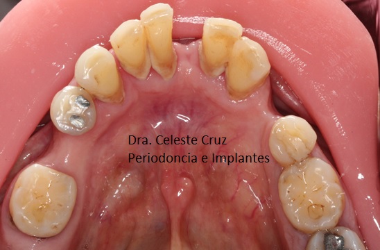 Introducción a la Periodoncia: 2017