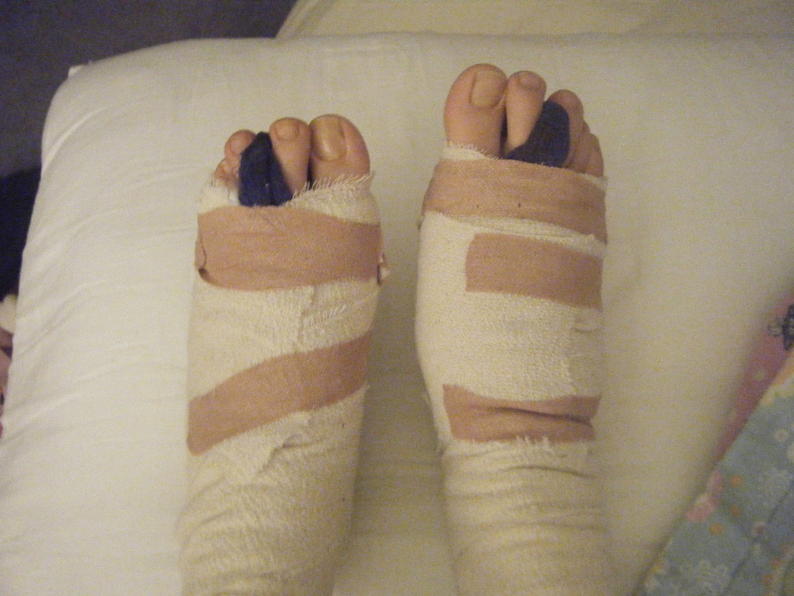 Syndactyly separation