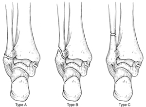 Cirurgia para tratamento da Fratura de Tornozelo