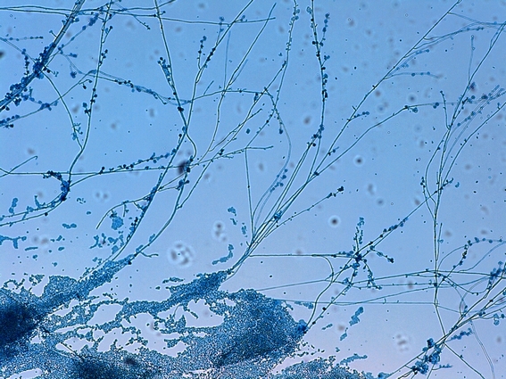 Fun With Microbiology (What's Buggin' You?): Exophiala dermatitidis