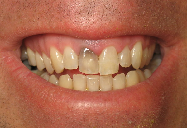 The Teeth-Ing Troubles: Trauma To The Tooth