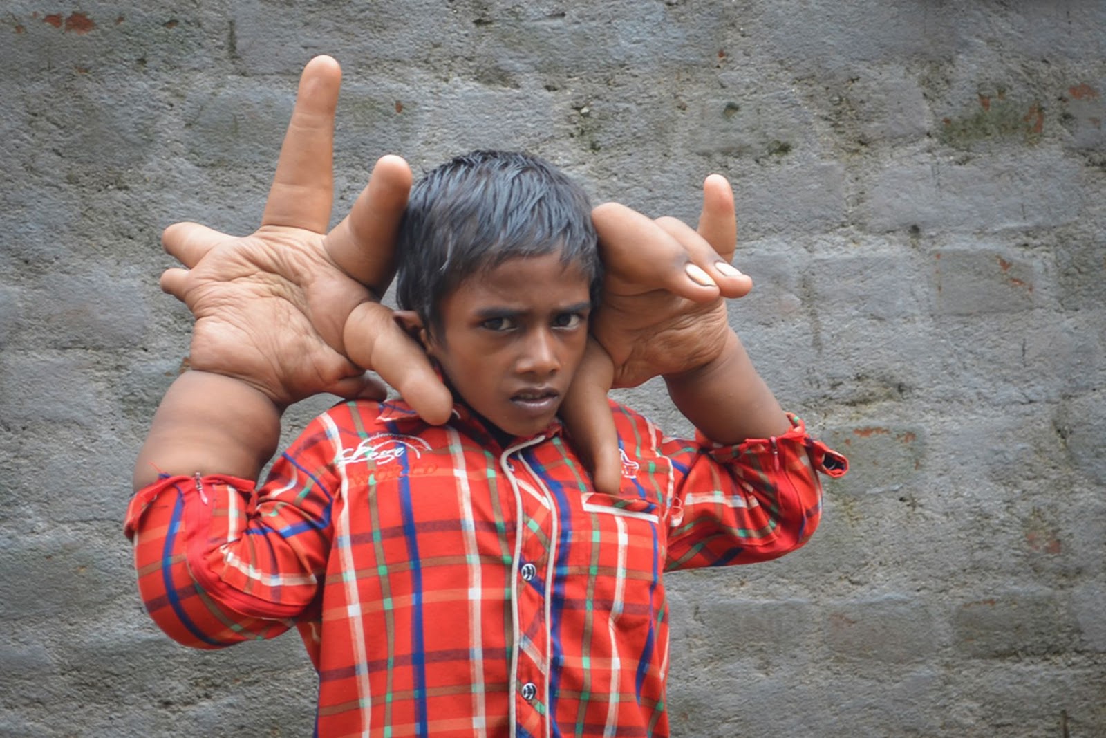 Boy with giant hands gets pioneering surgery after being dubbed 'the ...