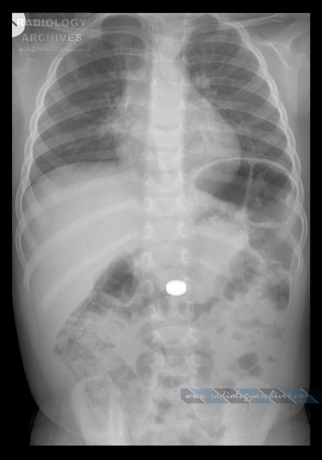 Radiology Archives: Ξένο Σώμα (Button Cell Battery) στον Στόμαχο
