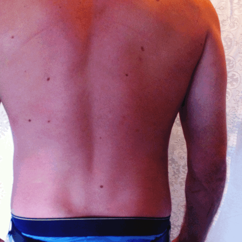 The Hip Joint: Quadratus Lumborum