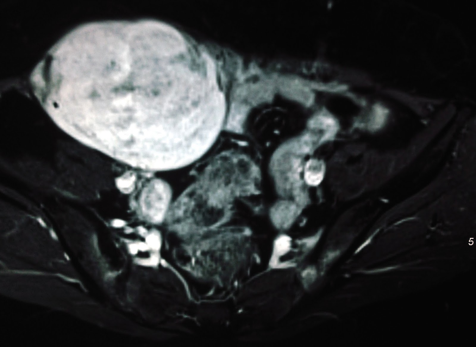 VIETNAMESE MEDIC ULTRASOUND: CASE 361: TUMOR of MUSCLE RECTUS ABDOMINIS ...