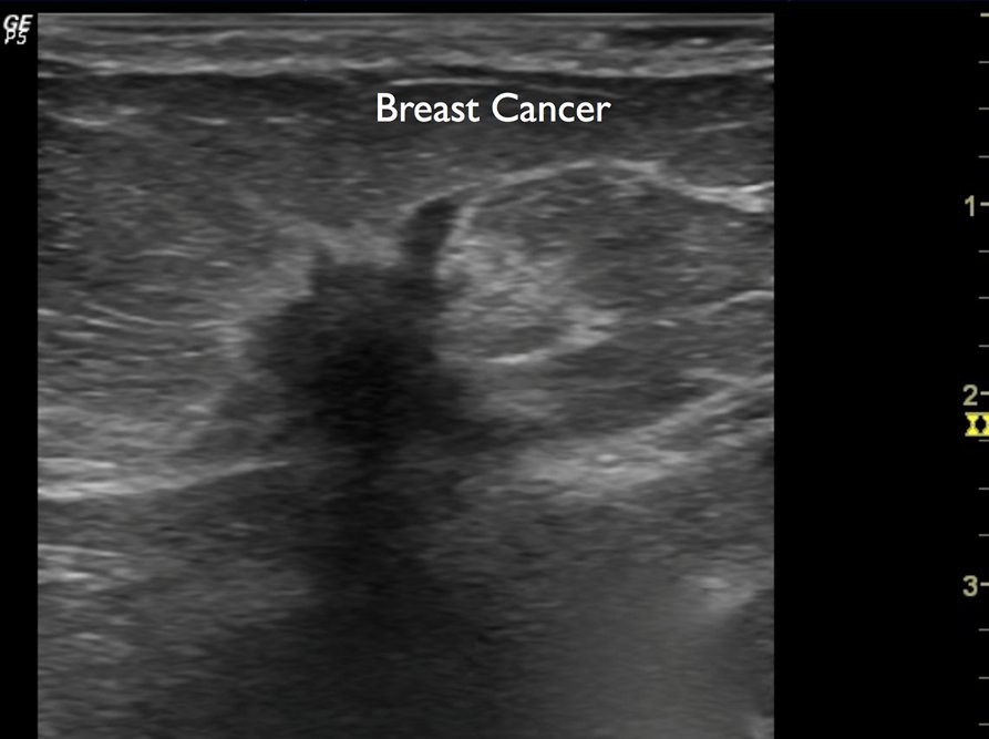 MEDICAL ULTRASOUND / BREAST CANCER