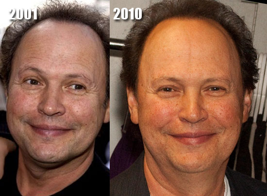 Billy Crystal Plastic Surgery