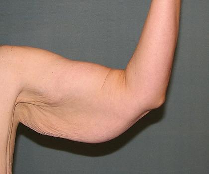 Arm Lift and Liposuction Reduce or Get Rid of Excess Skin