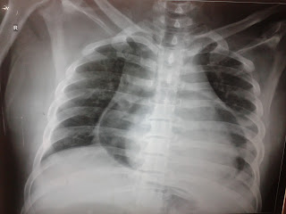 Non-traumatic Pneumopericardium-CXR - Sumer's Radiology Blog