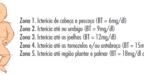 Semiologia Pediátrica : Icterícia neonatal - Zonas de Kramer