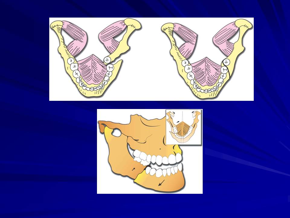 Dr. Alex Polit Luna- Cirujano Oral y Maxilo Facial.: Fractura Mandibular