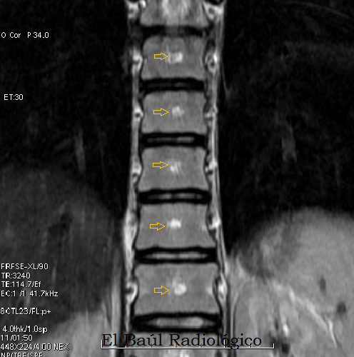 El Baúl Radiológico: VENAS BASIVERTEBRALES. (Basivertebral Veins: CT ...