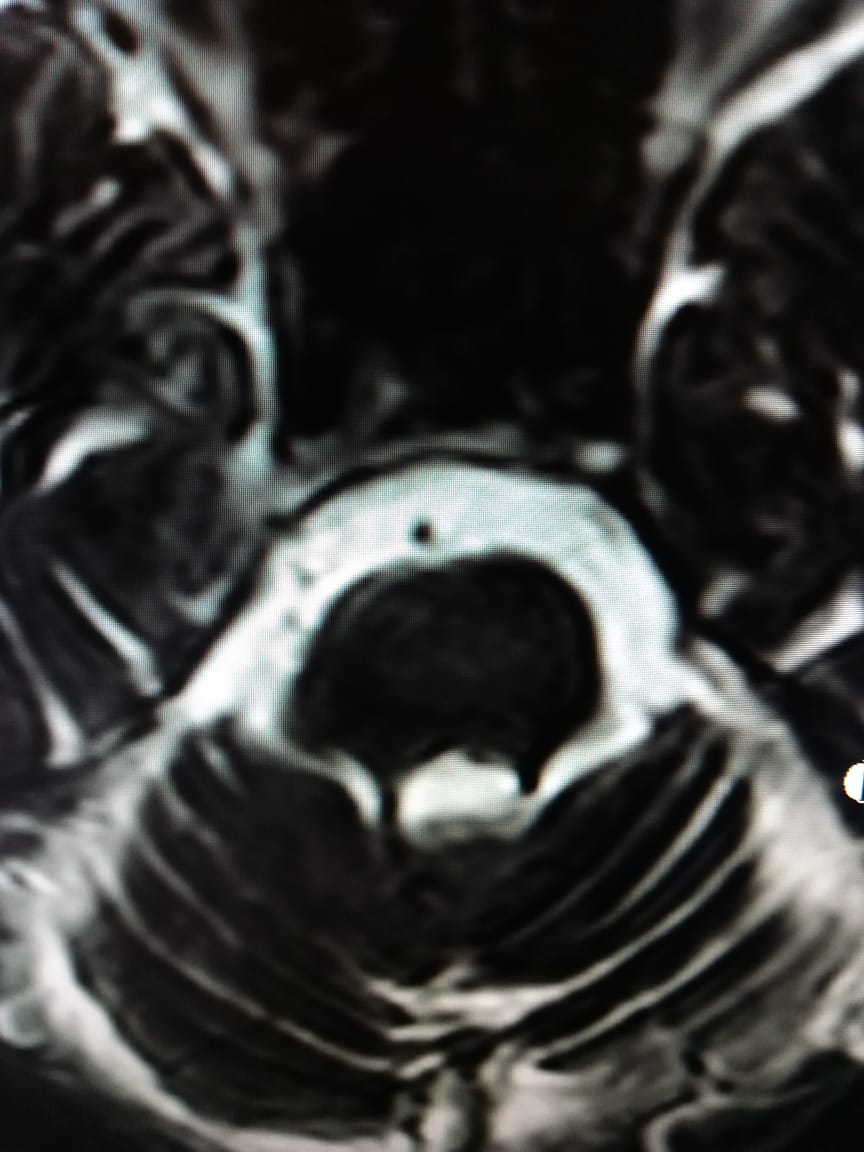 Progressive Supranuclear Palsy: MRI - Sumer's Radiology Blog