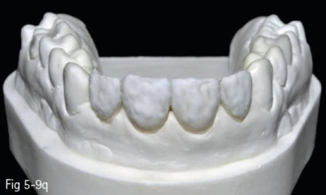 Lab techniques “ Cut-back “ | Dental Esthetics