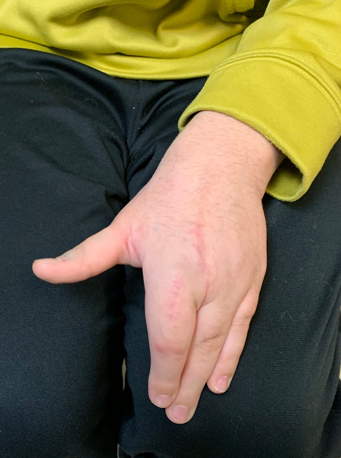 Cleft Hand: Beyond the Basics | Congenital Hand and Arm Differences ...