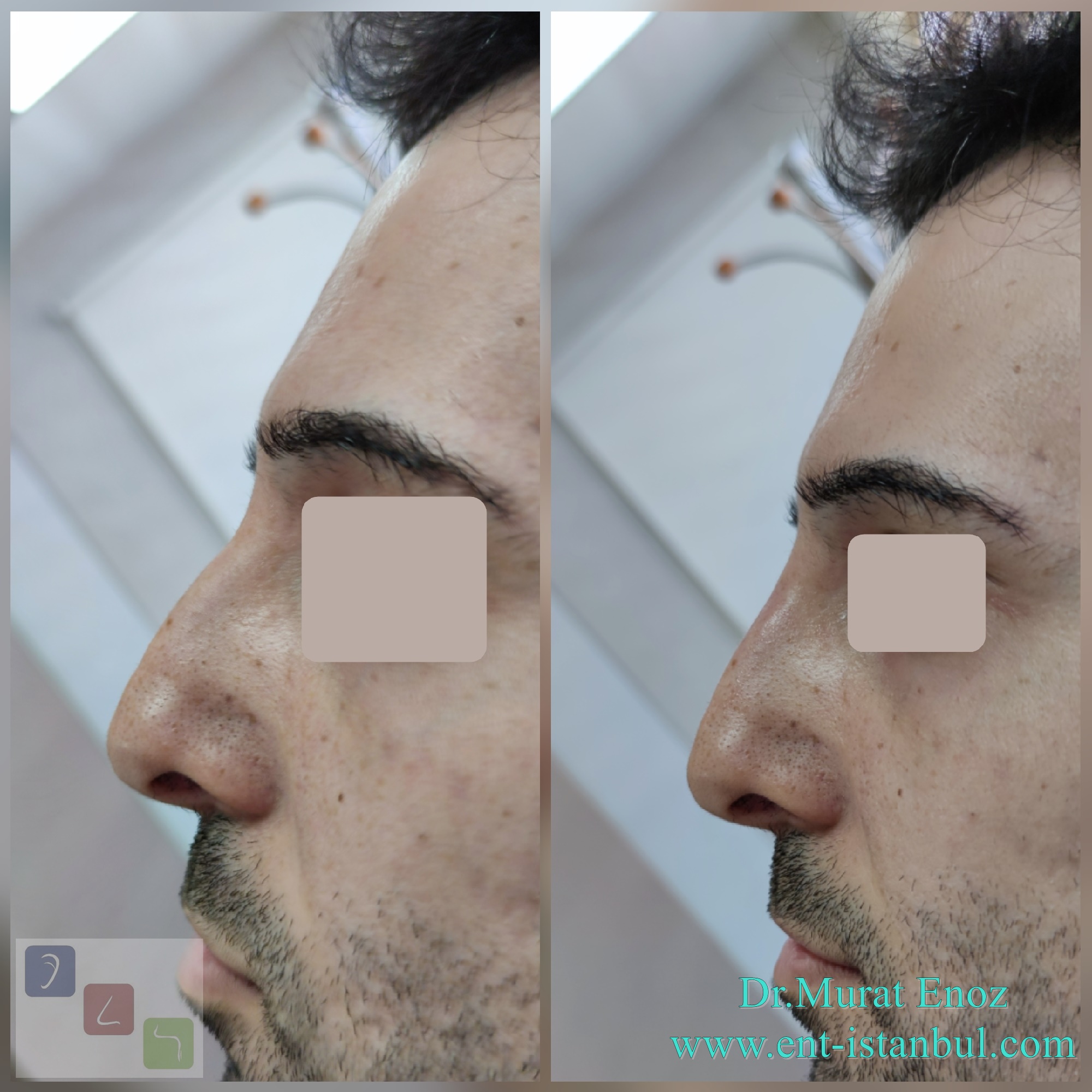 5 Minutes Nose Job With Filler in Istanbul