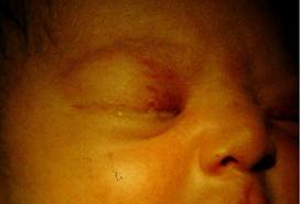 ASKEP Pada Pasien Dengan Infeksi Neonatal