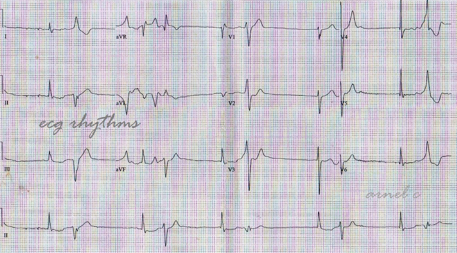 How To Diagnose Pvcs On Ecg at Kate Wardill blog