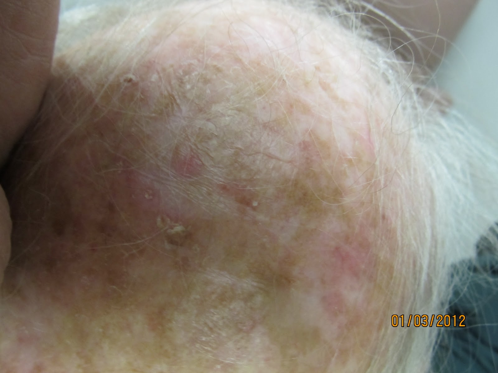 PrunePicker: Three stitches in the old scalp.