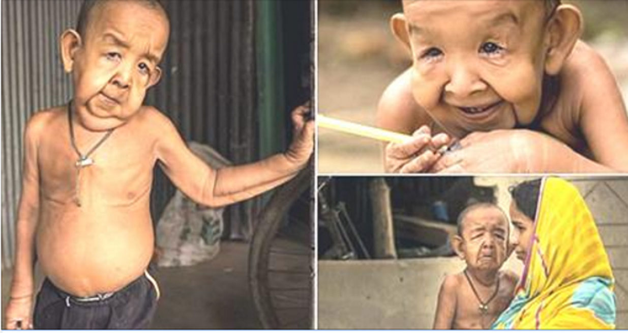 This Real Life Benjamin Button Is four, But Can’t Go To School Because ...