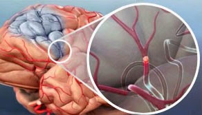 Stroke Wise: What is a stroke?