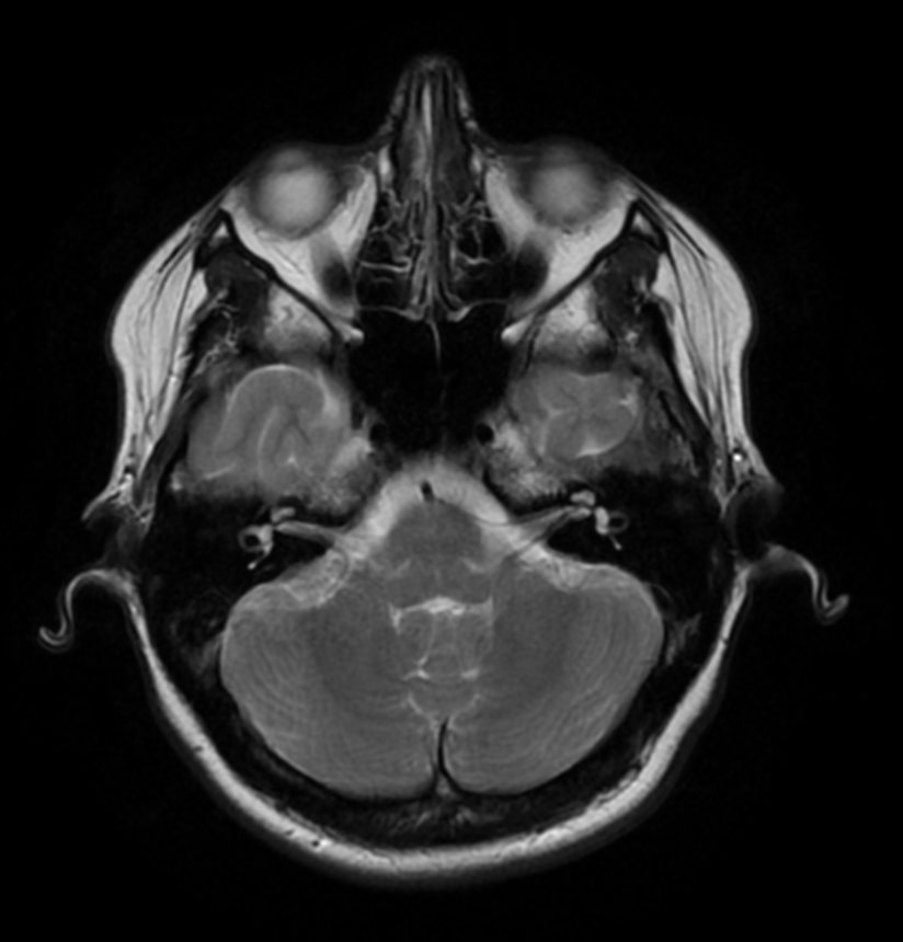 Eustachian tube dysfunction...forever?: My never-ending ear problem