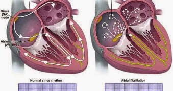 Atrial Fibrilasi | INA - ECG