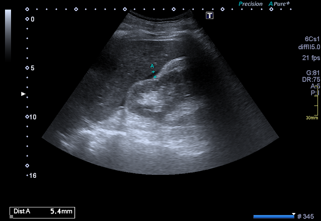 Medical Terms & Сlinical Сases : Morison’s pouch