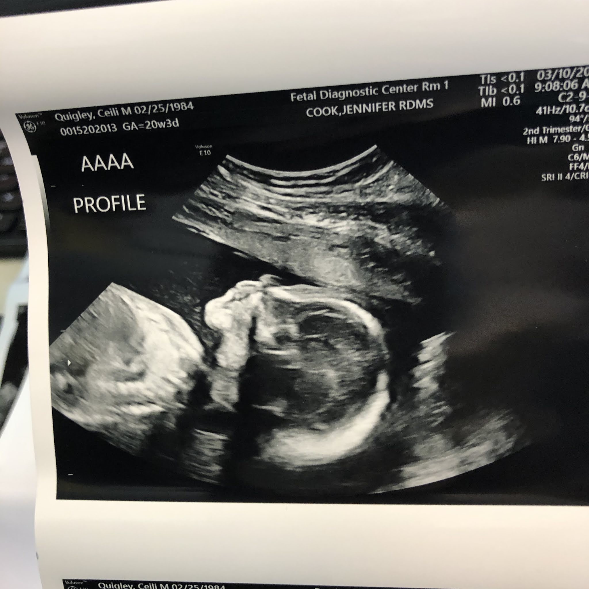 The Stork 2020: 20 week Anatomy Scan Ultrasound! 3/10/2021