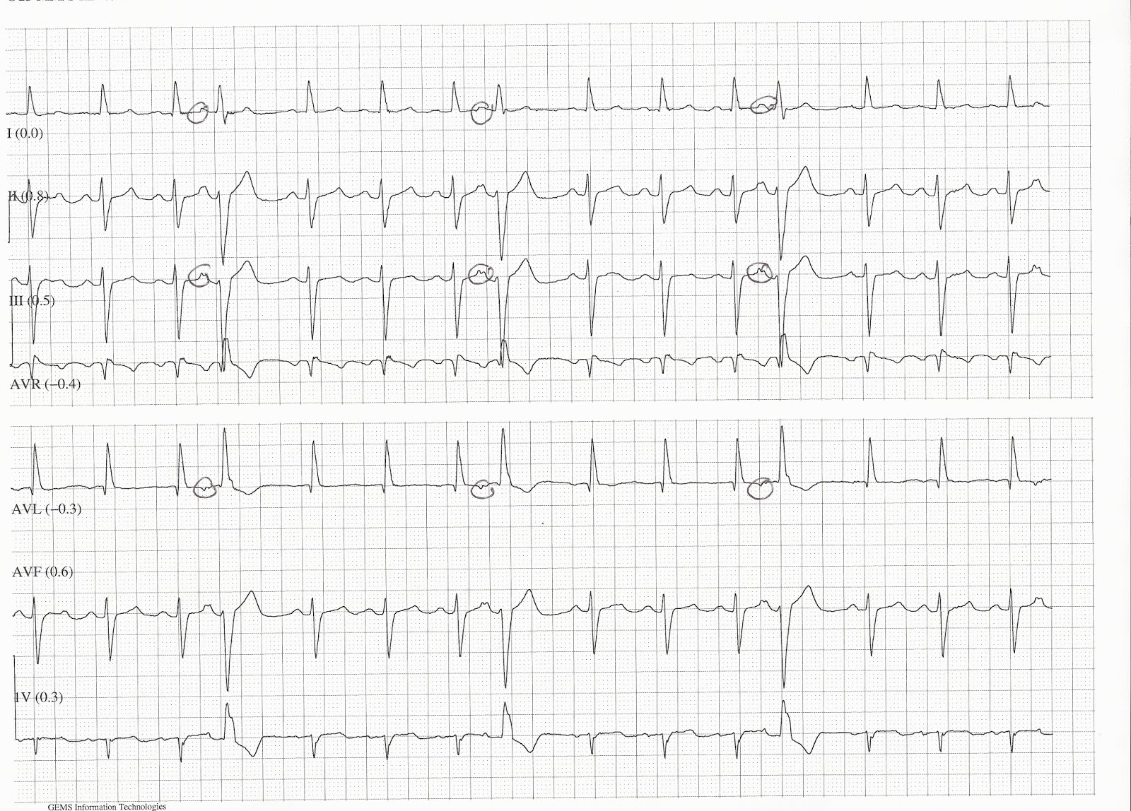 Bigeminal dropped PACs