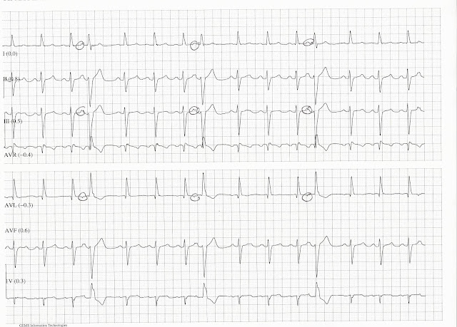 Bigeminal dropped PACs