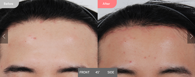 [ATOP Plastic Surgery Korea] Forehead Reduction (Forehead shortening ...