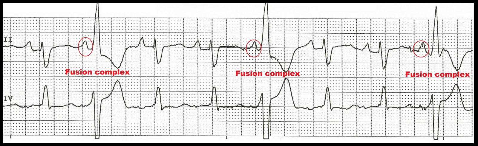 Float Nurse: Practice EKG Rhythm Strips 175