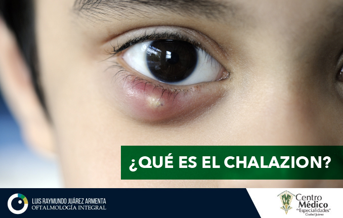 ¿Qué es el chalazion?