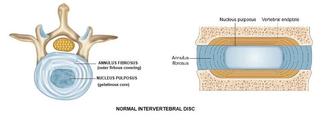 CLASSIFICATION OF HERNIATED DISC