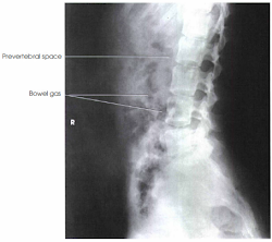 Lateral Projection of Abdomen - RadTechOnDuty