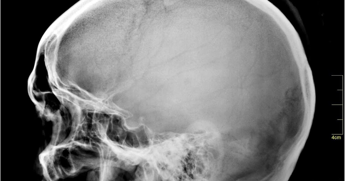 DERAMA: SKULL RADIOGRAFY