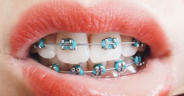 Ortodoncia: ¿COMO BESAR CON BRACKETS?