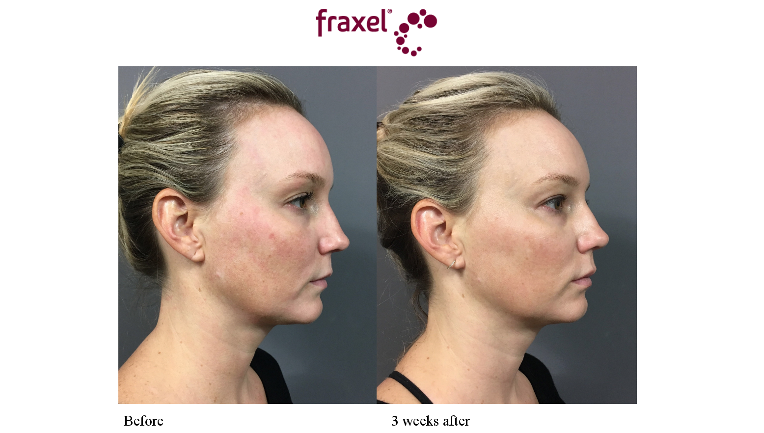 FRAXEL AT GERMAIN DERMATOLOGY | Germain Dermatology