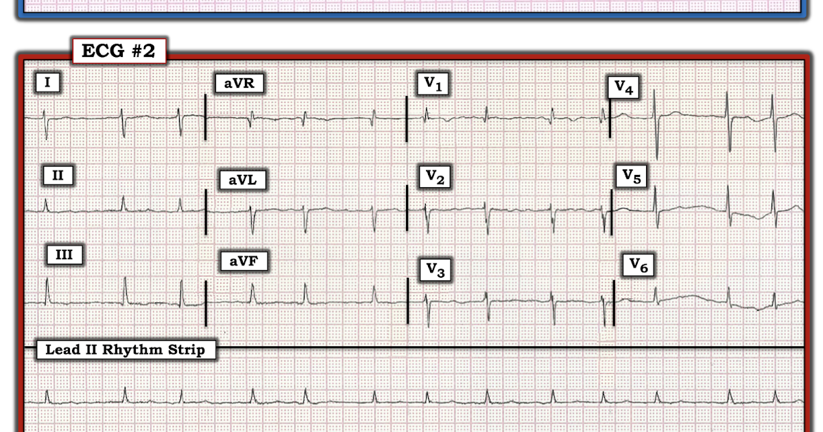 ECG Interpretation: ECG Blog #248 (62) — A qR in Lead V1