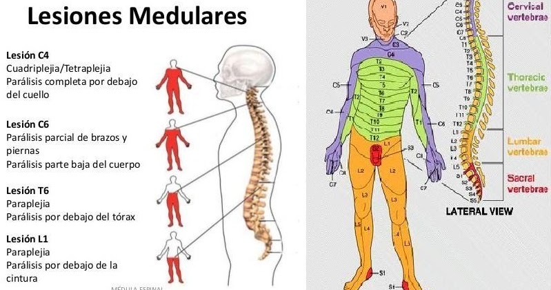 Discapaaccesible: Aumento en verano de lesionados medulares en Galicia