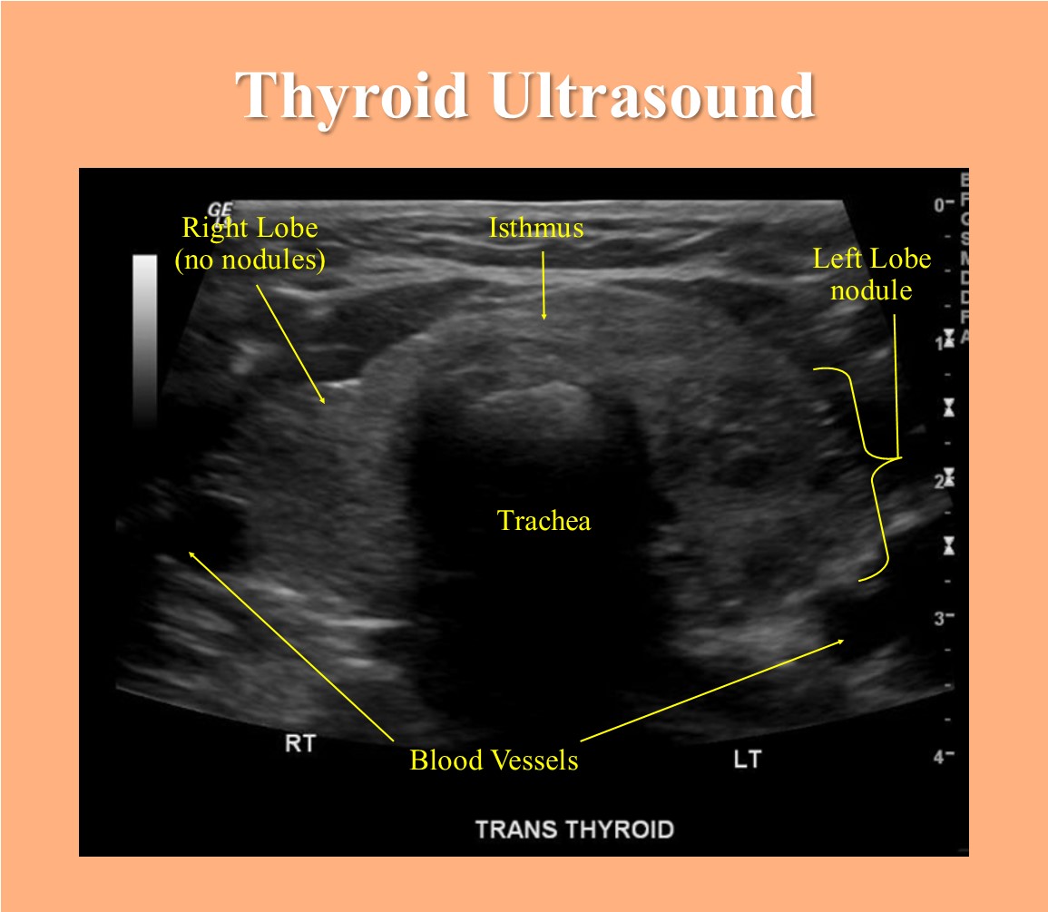 Thyroid Nodules