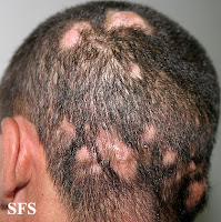 Scalp Problems: Treatment tips for Bumps on scalp