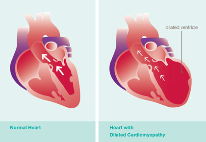 Cardiomyopathy: Types, Classification, Pathogenes & Symptoms 2020 ...