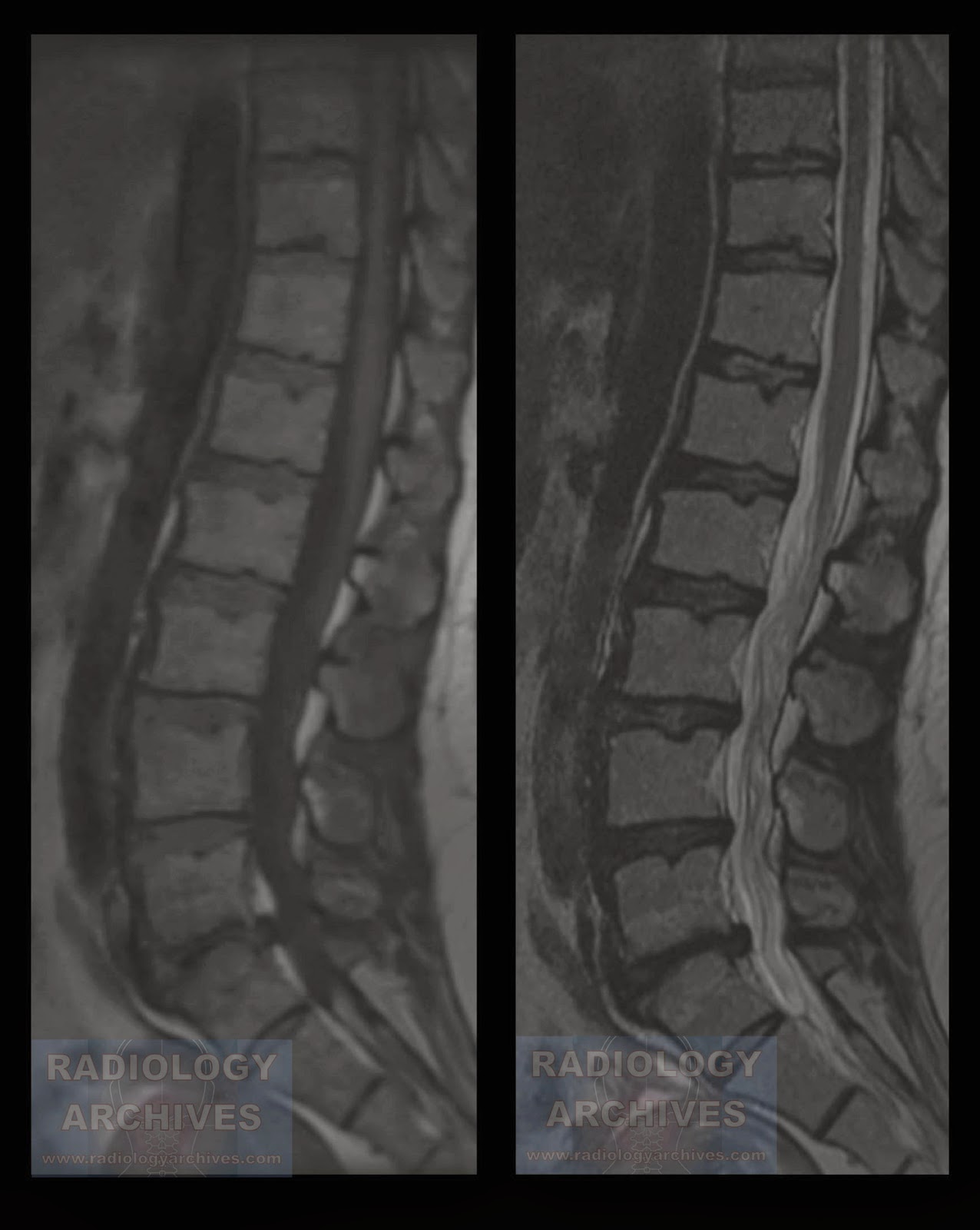 Radiology Archives: Όζοι (κήλες) του Schmorl
