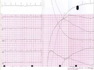 Mengetahui Atrial Fibrillation