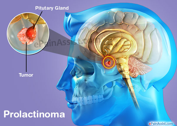 Prolactinoma - Tumor Benigno da Glândula Hipófise | Saúde e Conhecimento