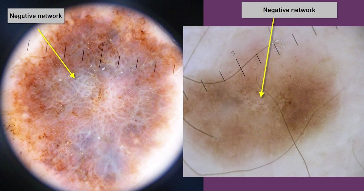 Dermoscopy Features As Clues Lines White dermoscopy-features-as-clues-lines-white