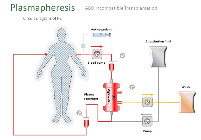 Gene Therapy and Re-dosing Strategy- Removal of Preexisitng anti-AAV ...